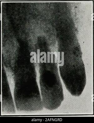 . Dental electro-therapeutics. Fig. 94 Fig. 95 12 178 THE X-RAYS OR ...