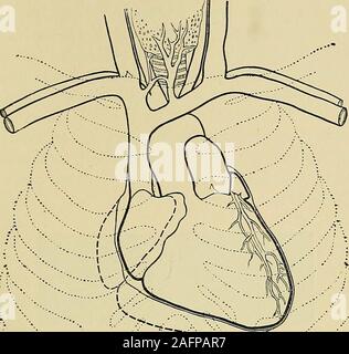 . Diseases of the heart and thoracic aorta. tion ofthe apex beat to the ...