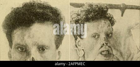 Walter Yeo Skin Graft