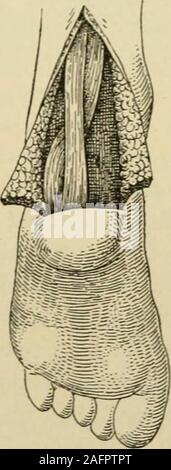 . Manual of operative surgery. Make the U-shaped incision A B C D (Fig ...