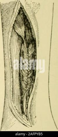 . Manual of operative surgery. Step 6.—Close the wound in layers ...