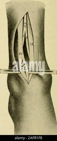 . Manual of operative surgery. Step 6.—Close the wound in layers ...