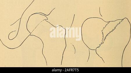 Smith fracture, X-ray Stock Photo - Alamy