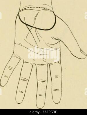 . Manual of operative surgery. Fig. 1427. Fig. 142? Figs. 1427 and 142S ...