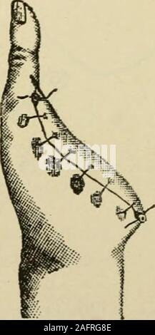 . Manual of operative surgery. Fig. 1427. Fig. 142? Figs. 1427 and 142S ...