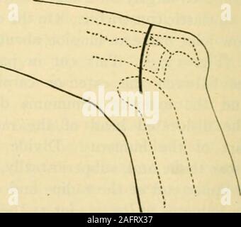 . Manual of operative surgery. Make the U-shaped incision A B C D (Fig ...