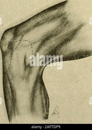 . Manual of operative surgery. Make the U-shaped incision A B C D (Fig ...