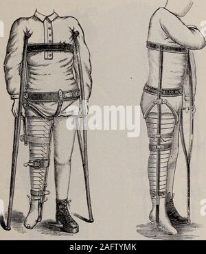 . Buffalo medical journal. Splint. Fig. 8. Fig:s. 8 and g, illustrate ...