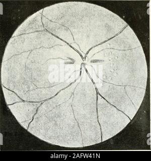 . Oftalmología; estadística [1.]-3. ser. ;? .? i, o. I. Coroiditis ...