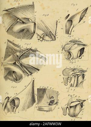 INGUINAL HERNIA, DRAWING Stock Photo - Alamy