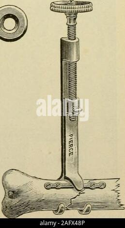 plate, fracture, plates, fractures Stock Photo - Alamy