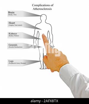Complications of Atherosclerosis Stock Photo - Alamy