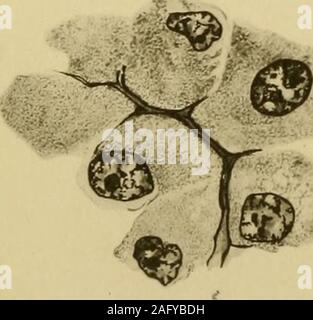 Medical and surgical reports . of connective tissue inthe bladder-wall ...