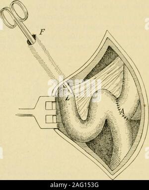 . Manual of operative surgery. -^ inches below theHarrison Crippsline ...