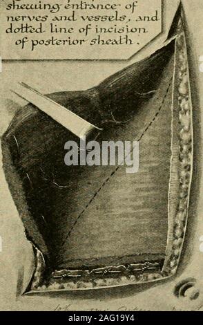. Manual of operative surgery. -^ inches below theHarrison Crippsline ...