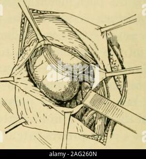 . Manual of operative surgery. 2 inch in front of the adductor magnus ...
