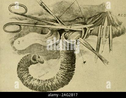 . Manual of operative surgery. Fig. 607. 2. Intussusception withdrawn ...