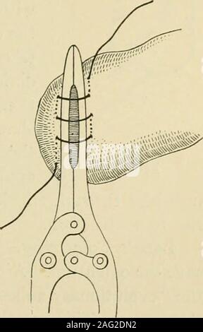. Manual of operative surgery. into the lumen of the gut by apurse ...