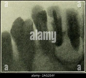 . Dental electro-therapeutics. Abscess on lower molar showing ex ...