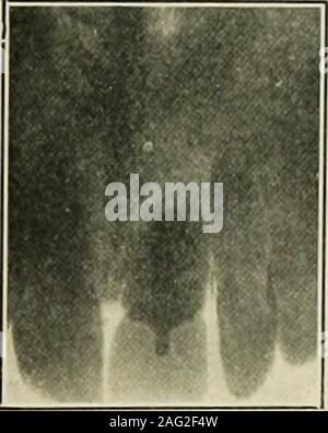 . Dental electro-therapeutics. Fig. 102. Case of fistula of right upper ...