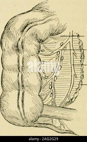 . Manual of operative surgery. the end of the ileum to the side of the ...
