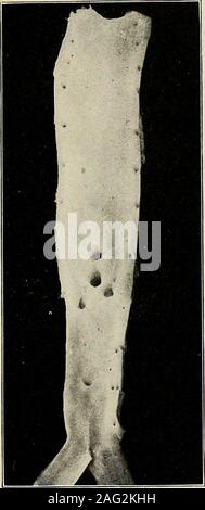 . Arteriosclerosis : etiology, pathology, diagnosis, prognosis ...