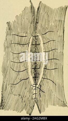 . Manual of operative surgery. Step 6.—Close the wound in layers ...