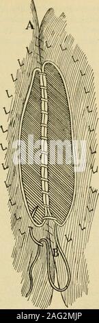 . Manual of operative surgery. Step 6.—Close the wound in layers ...