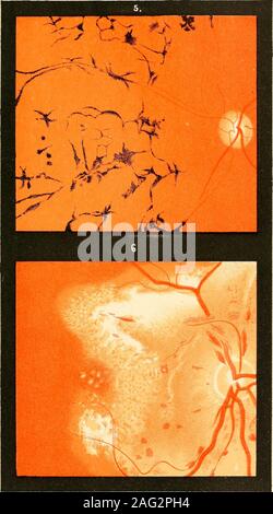 . A treatise on the diseases of the eye. y margin and anterior capsule ...