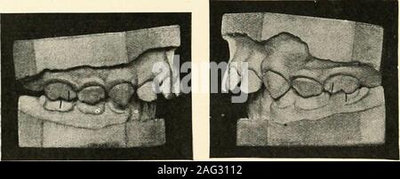 . The Dental cosmos. Normal occlusion of molars: transverse section ...