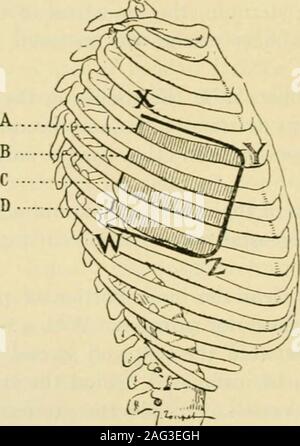 . Manual of operative surgery. Step 6.—Close the wound in layers ...