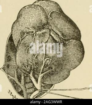 . Manual of operative surgery. {Kocher.) Step 2.—With the finger ...