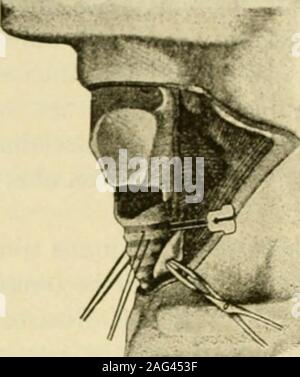 . Manual of operative surgery. Make the U-shaped incision A B C D (Fig ...