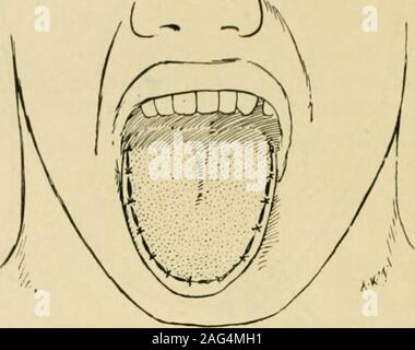. Manual of operative surgery. Make the U-shaped incision A B C D (Fig ...