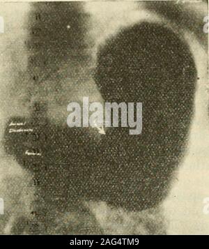 . Modern surgery, general and operative. n and fixation or removal ...