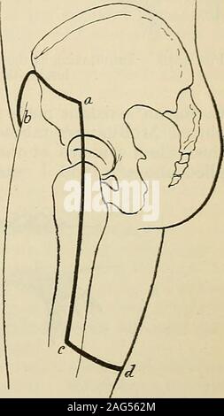 . Modern surgery, general and operative. Various forms of appendicitis ...