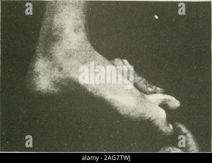 Medical and surgical therapy . ORS OF THE SMALL TOES, following ...