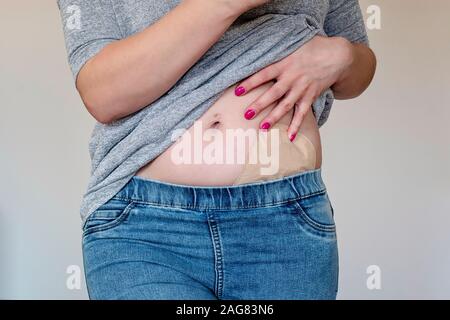 Close-up view on colostomy on a baby patient. Selective focus on child ...