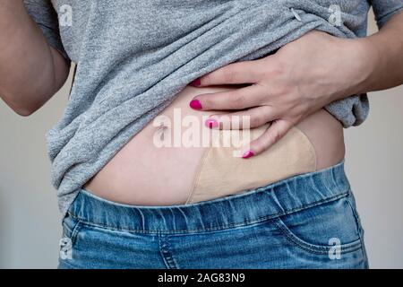 Close-up view on colostomy on a baby patient. Selective focus on child ...