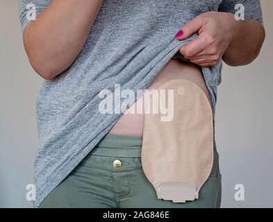 Close-up view on colostomy on a baby patient. Selective focus on child ...