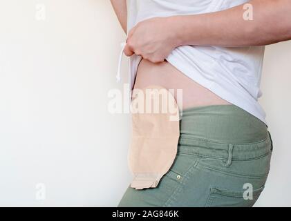 Close-up view on colostomy on a baby patient. Selective focus on child ...