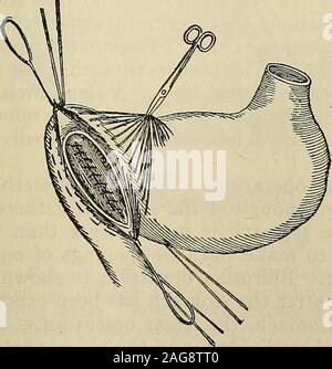 Modern surgery, general and operative . s pyloroplasty: Theincision ...