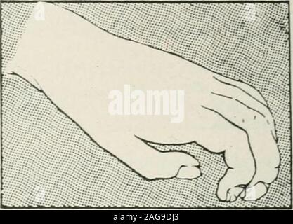 . Medical and surgical therapy. median and ulnar nerves on the ...