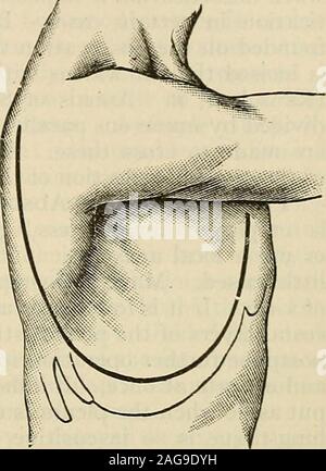 Modern surgery, general and operative . es, are angled, nodular,fiirm ...