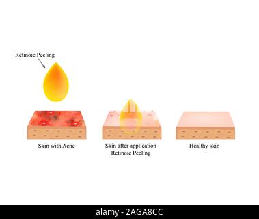 Retinoic peeling for acne. Inflamed skin acne. Acne purulent. The ...