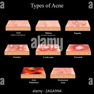 Types of Acne Skin inflammation. Pimples, boils, whitehead, closed ...