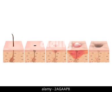 Treatment of open comedones, inflamed acne, acne cysts. Sore acne. The ...