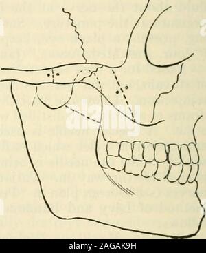 . Modern surgery, general and operative. the zygoma to the supra ...
