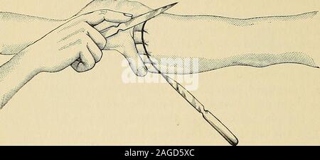 . Operative surgery. Fig. 561.—Incisionfor plantar flap. Fig. 562 ...