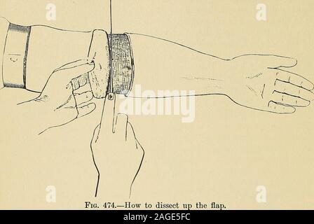 . Operative surgery. ^ The Oval or Racket Method.—The oval or ...